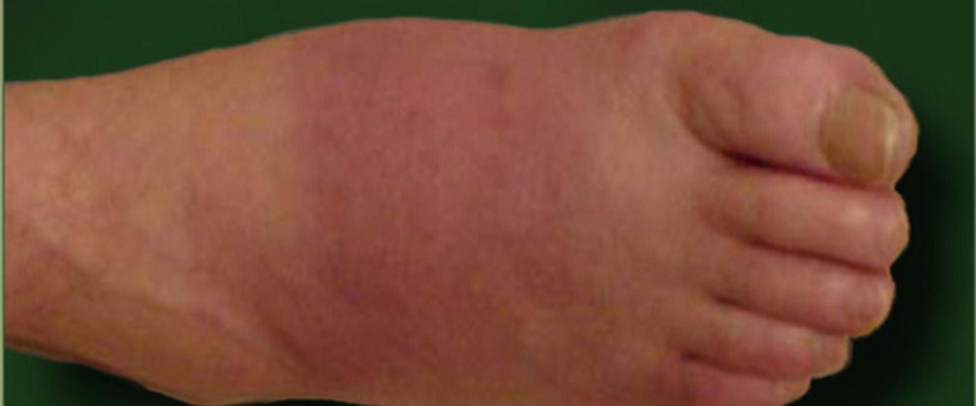 Understanding the Grades of Charcot Foot