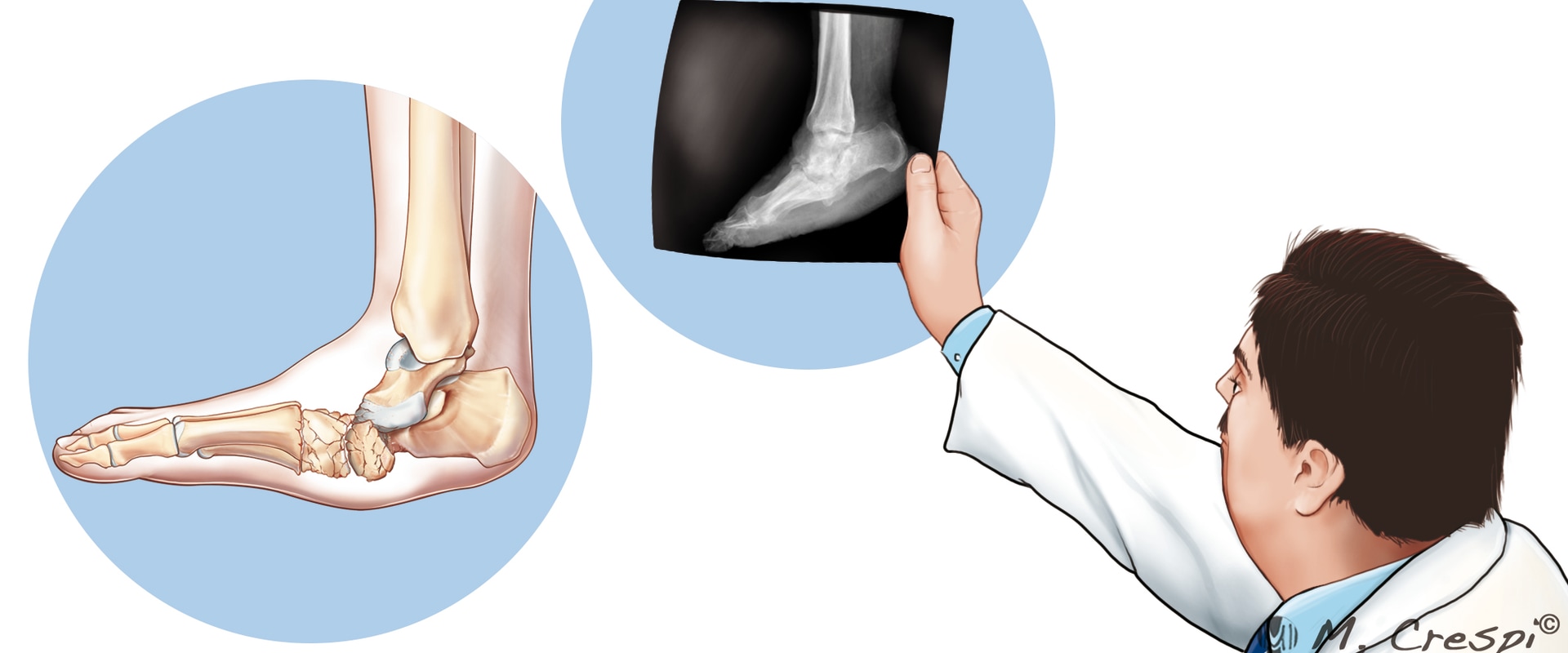 Charcot Foot: Diagnosis and Treatment Strategies