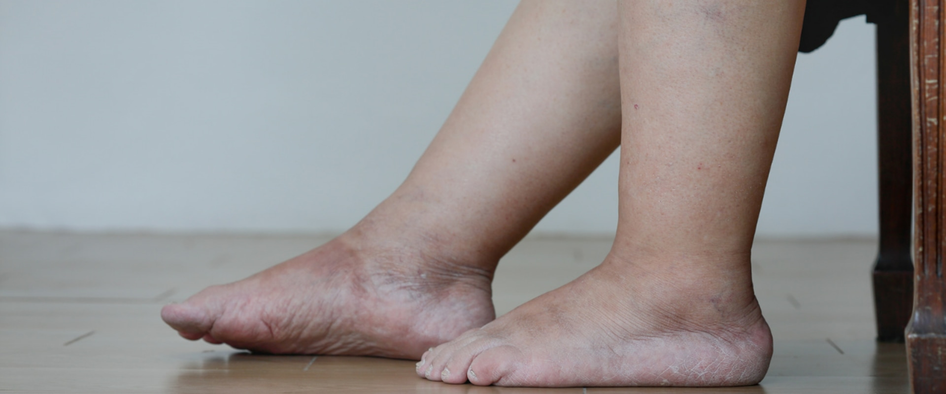 How long does the acute phase of charcot last?