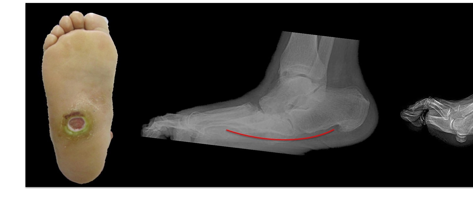 Charcot Foot: Understanding the Condition and How to Prevent It