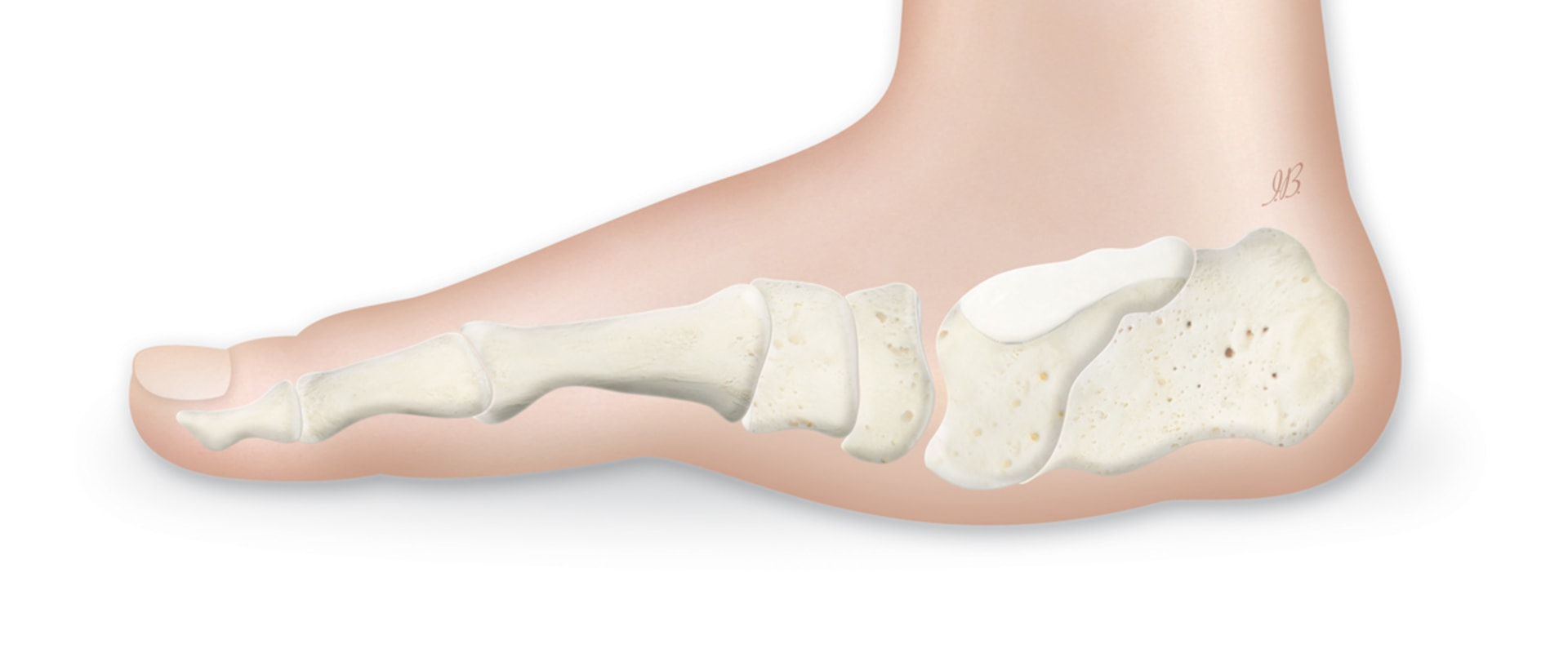 Understanding Charcot Foot: A Neurological Disease